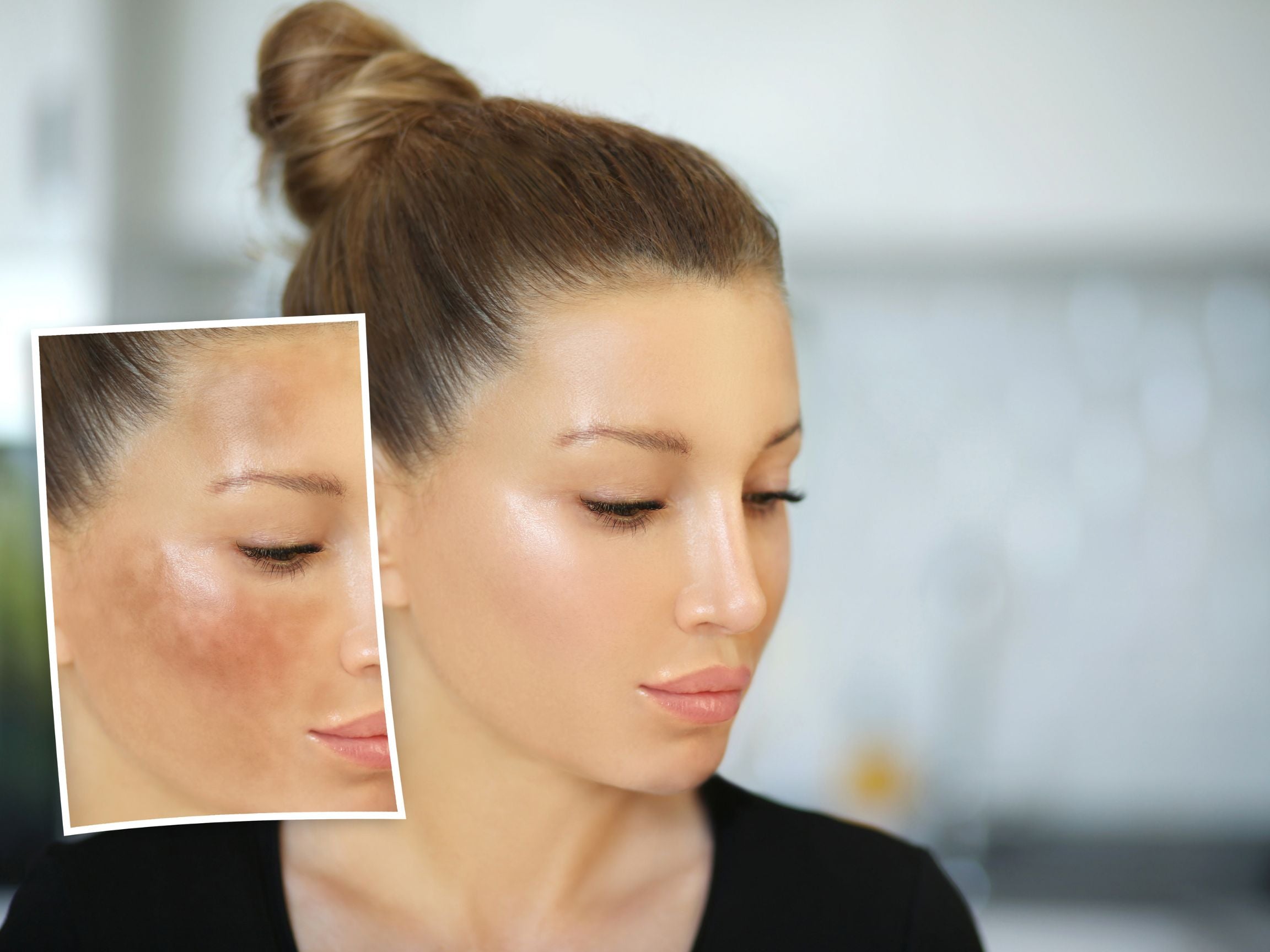 hyperpigmentation fading