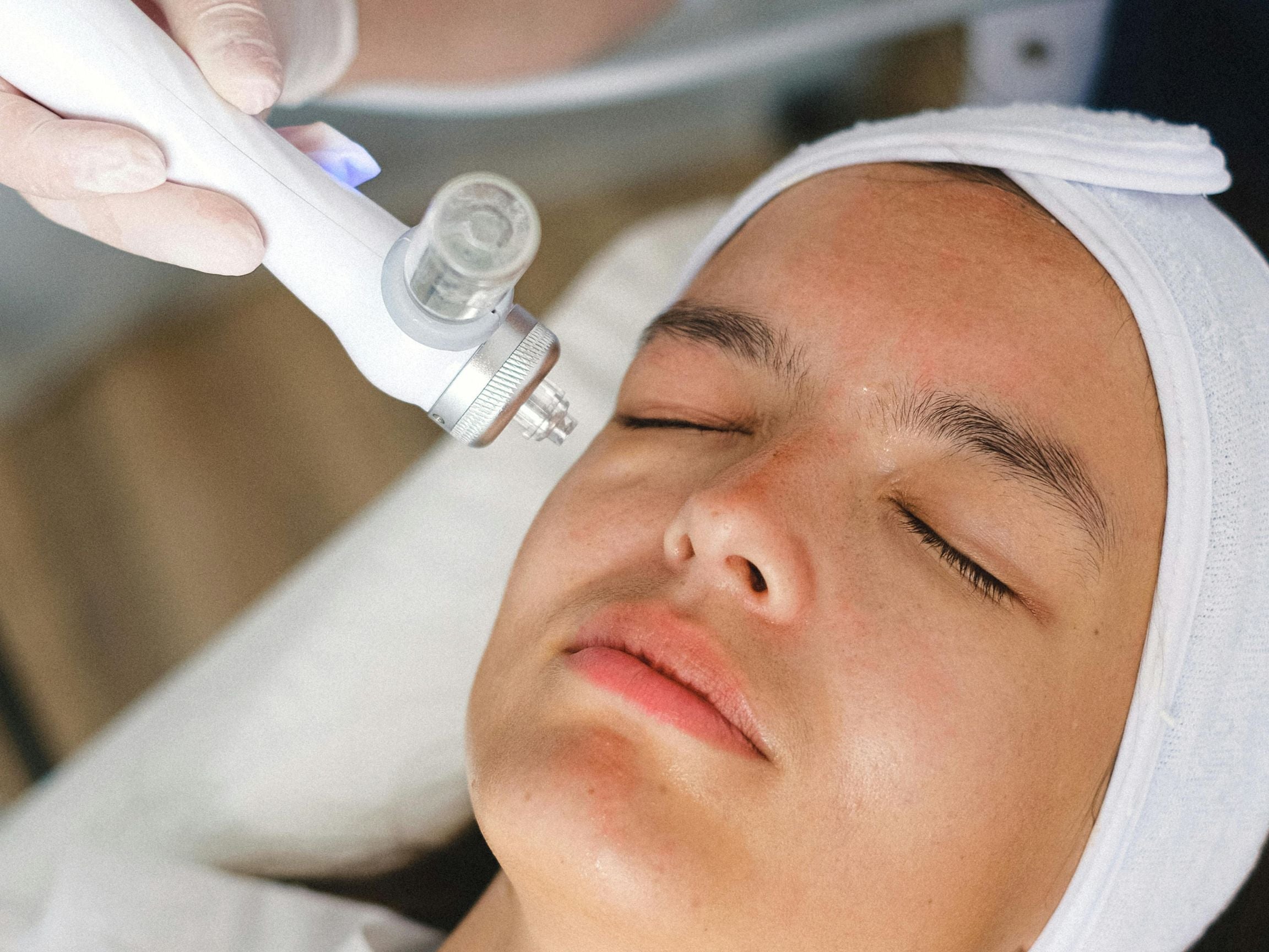 Laser Treatments for Redness & Pigmentation | Sol Skin Spa