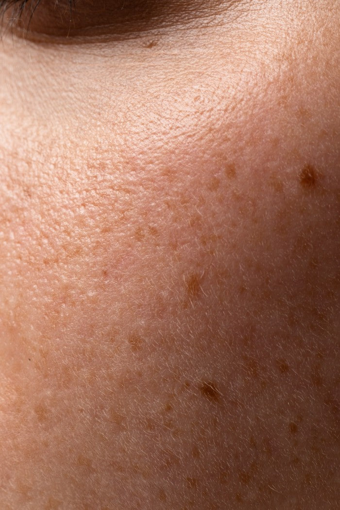 Skin Texture & Enlarged Pores Treatment | SOLSKIN SPA | Canada's ...